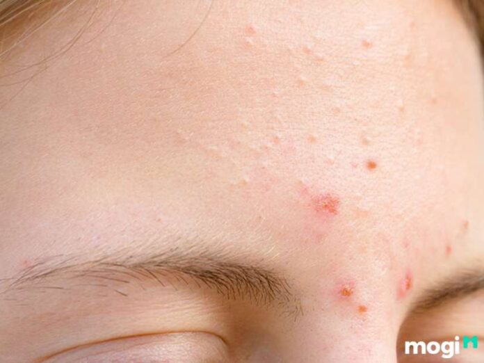 Lông Trắng Mọc Trên Mặt là gì? Lý Giải Lý Do Lông Trắng Mọc Trên Mặt